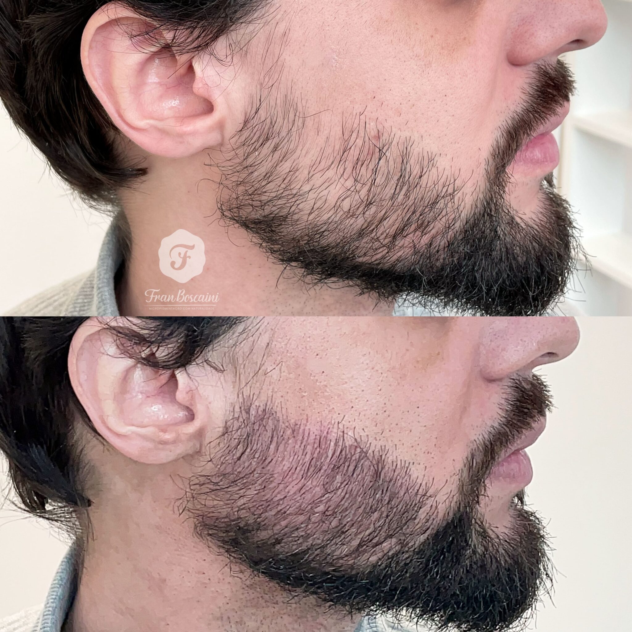 Micropigmentação de Barba Fio a Fio (Nanoblading) - Fran Boscaini ...