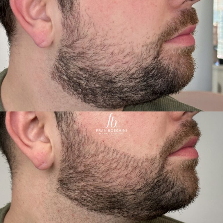 Preenchimento Imediato de Barba: Entenda Como Funciona a Técnica de ...