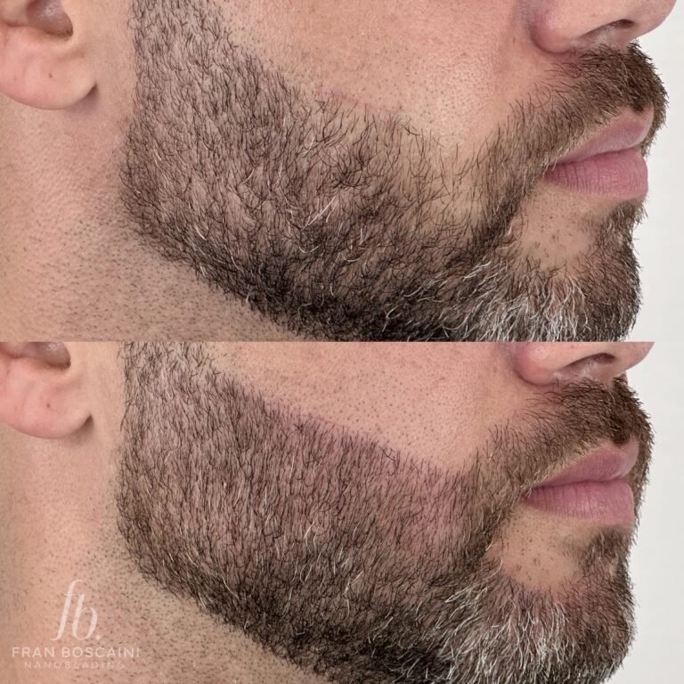 Preenchimento Imediato de Barba: Entenda Como Funciona a Técnica de ...