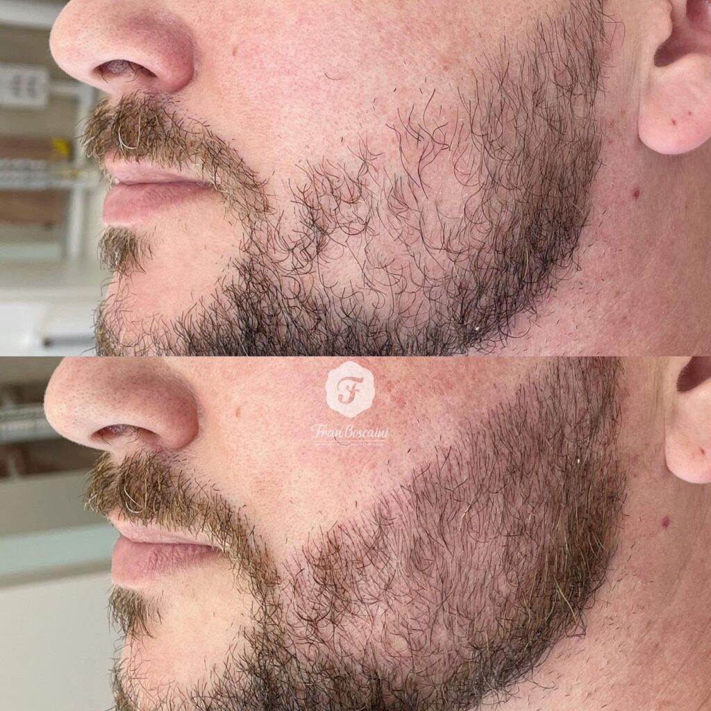 Preenchimento Imediato de Barba: Entenda Como Funciona a Técnica de ...